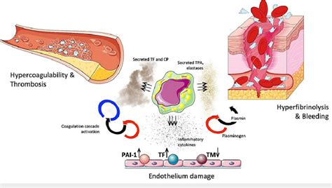 Disseminated Intravascular Coagulation Illustration By