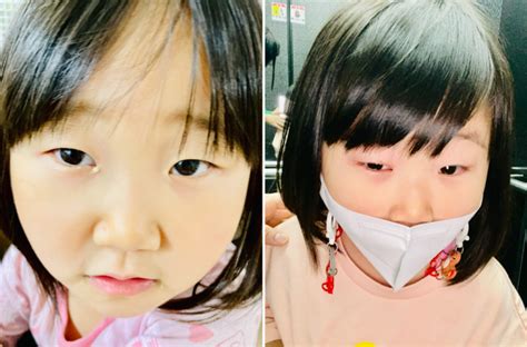 눈꼽감기 아데노바이러스 증상 아기 열 기침 가래 성인 전염 네이버 블로그
