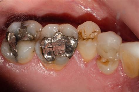 Fractured Molar Cusp Or Broken Crown On Molar Smiles By Bis