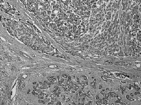 Combined Hepatocellular Cholangiocarcinoma Download Scientific Diagram