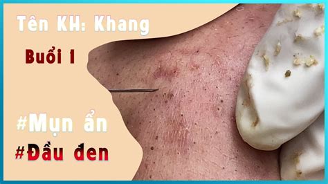 Big Cystic Acne Blackheads Extraction Blackheads And Milia Whiteheads
