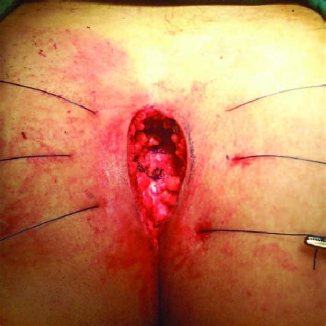 Intraoperative Photo Demonstrating Excision Of Pilonidal Complex With