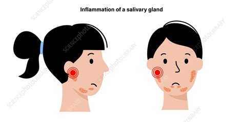 Salivary Gland Inflammation Illustration Stock Image F0363889