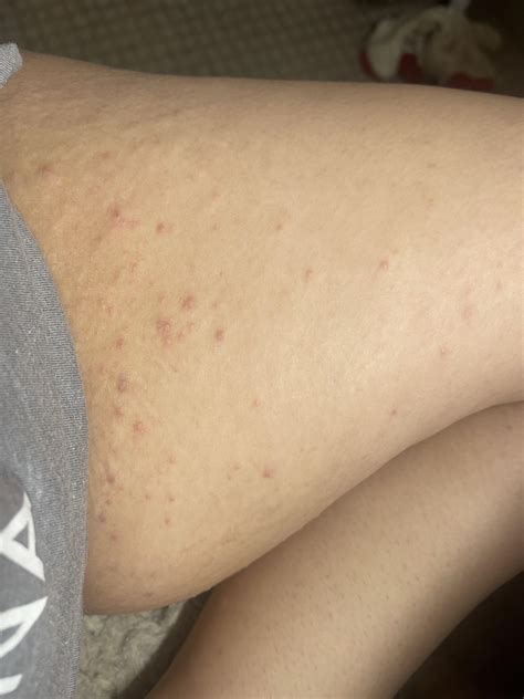 Any Idea What Kind Of Rash This Is Inner Thigh And Where My Arm Folds