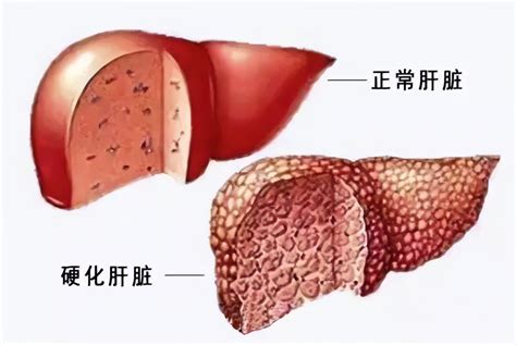 什么是肝纤维化？如何预防肝纤维化进展到肝硬化？ 哔哩哔哩
