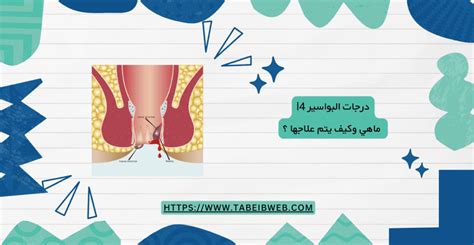 درجات البواسير 4 ماهي وكيف يتم علاجها ؟ طبيب ويب