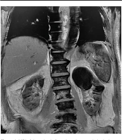 Figure 3 From A Case Of Streptococcus Mutans Endocarditis With Cardiac