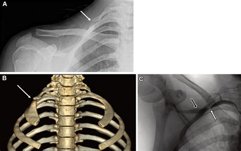Pediatric Ribs At Chest Radiography Normal Variants And Abnormalities