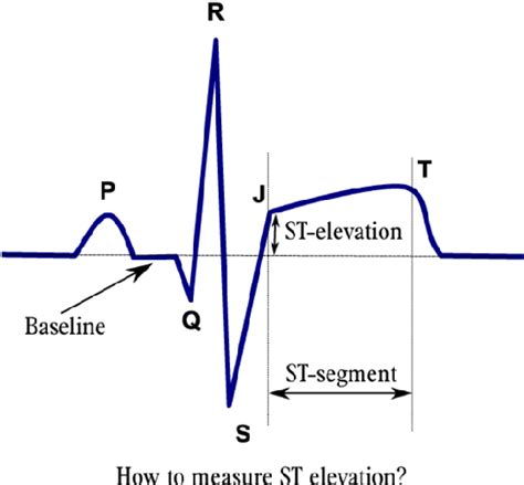Figure 3 From Biomedical Time Series Preprocessing And Expert System Based Feature Extraction In