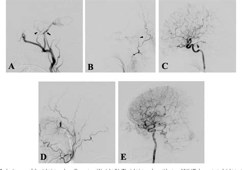 [pdf] Feasibility Of Metal Artifact Reduction On Ct Angiography For