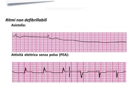 Attività Elettrica Senza Polso Pea E Asistolia Emd112 Prodotti E