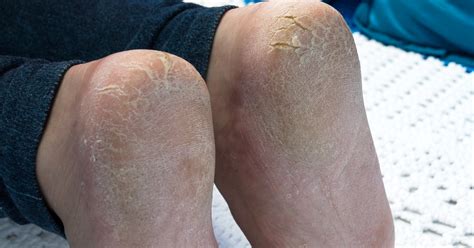 Ichthyosis Causes Treatments Optimists Wellness India