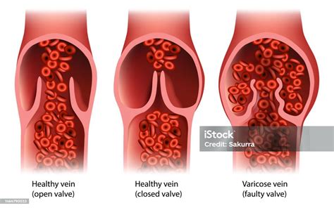 Insufisiensi Vena Kronis Atau Refluks Vena Penyakit Vena Varises Katup Rusak Vena Sehat