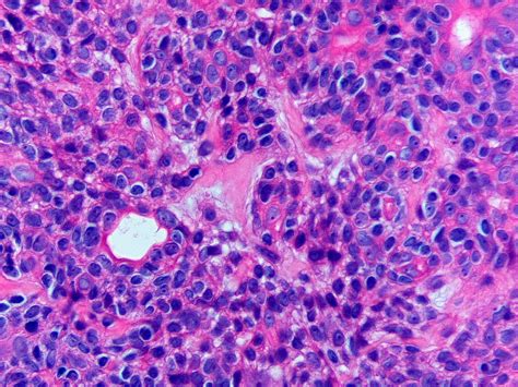 Poroma Of The Hip And Buttock