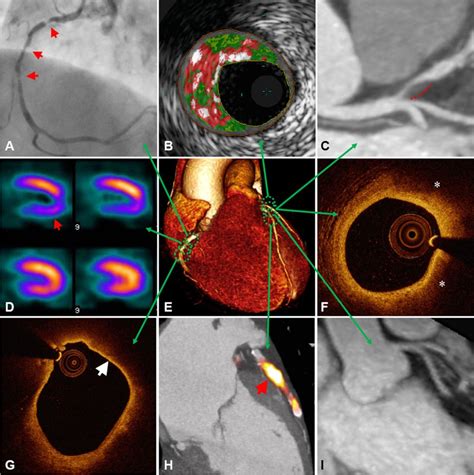 Imaging Atherosclerosis Circulation Research