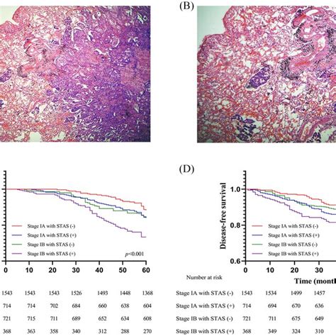 A Low Power View And B High Power View Of Tumor Spread Through Air
