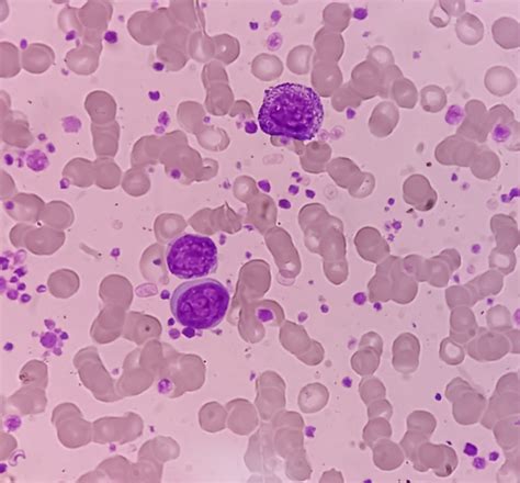Fda Approves Scemblix For Chronic Myeloid Leukemia First Line Treatment