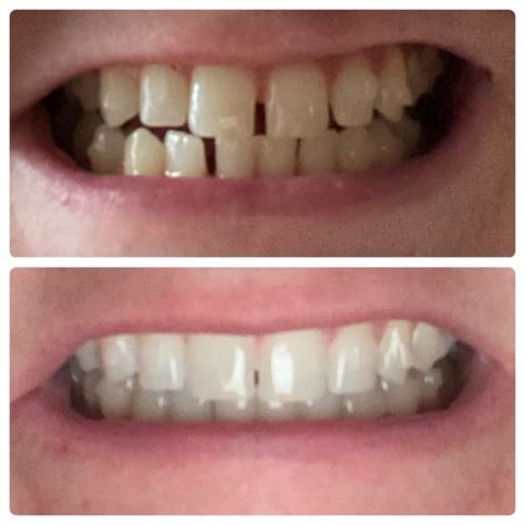 20 Weeks Of Progress 20 More To Go Rinvisalign