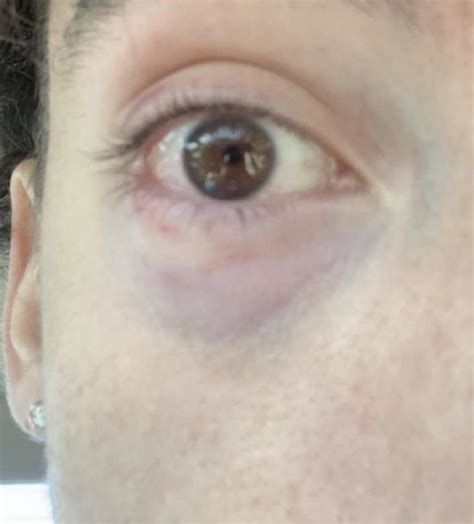 Polished Or Unpolished Edges On High Prescription 10 Diopters And