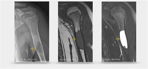 Unicameral Bone Cyst Calcaneus Surgery