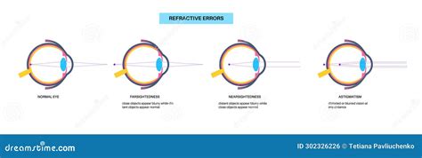 Refractive Errors Poster Stock Vector Illustration Of Hypermetropia