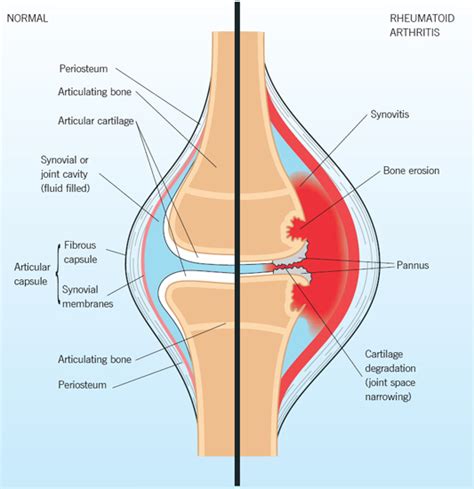 Rheumatoid Arthritis Diagram