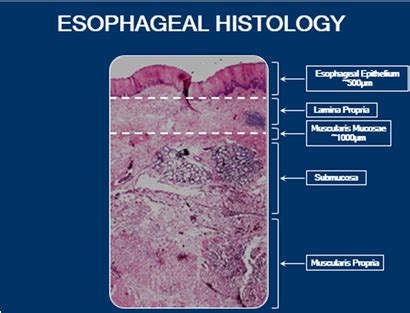 Understanding Barretts Esophagus