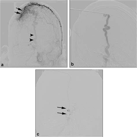 Absolute Ethanol Embolization Combined With Surgical Resection Of Scalp Arteriovenous