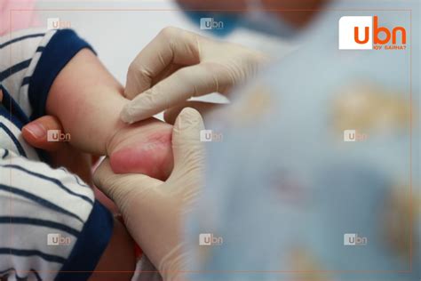 ХӨСҮТ Улаанбурхан өвчний лабораториор батлагдсан 2422 тохиолдол бүртгэгдсэн