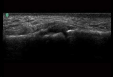 Hand Mcp Ulnar Collateral Ligament Image Sonosite Institute For Point Of Care Ultrasound