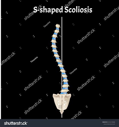 Sshaped Scoliosis Dextroscoliosis Levoscoliosis Spinal Curvature Stock
