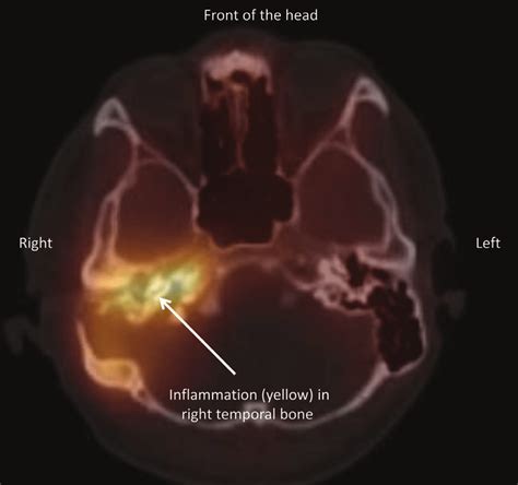 Axial Horizontal Technetium SPECT Nuclear Scan Showing Bony Download Scientific Diagram