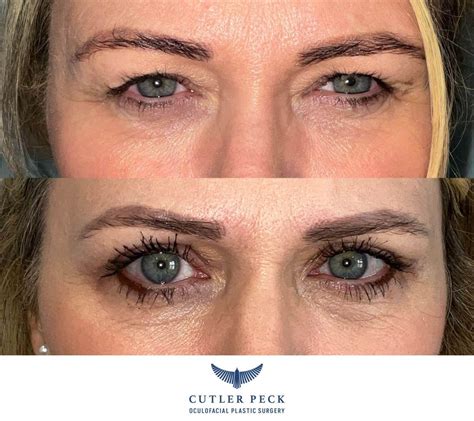 Female Bilateral Upper Eyelid Blepharoplasty Dr Cutler Peck