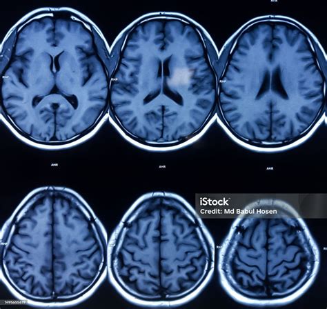 뇌의 자기 공명 영상 스캔 뇌 부비동 안구 및 두개골을 보여줍니다 Mri 스캐너에 대한 스톡 사진 및 기타 이미지 Mri