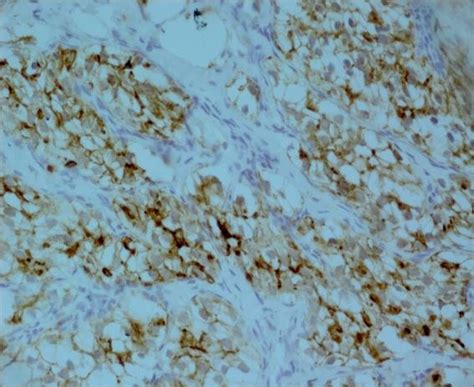 Cd10 Staining To Complete The Immunohistochemistry Panel Melan A