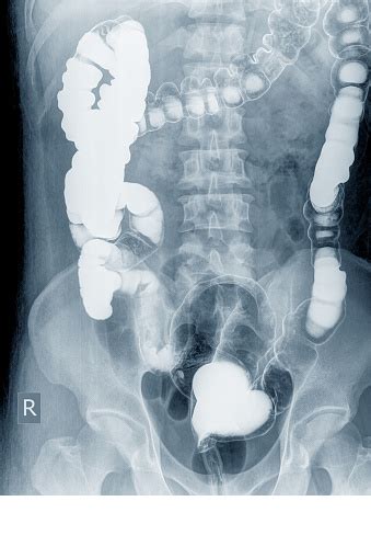 Examen Radiológico Para Buscar Anomalías En El Colon Por Enema El Polvo