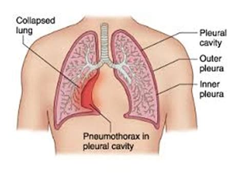 Collapsed Lung Meaning Pneumothorax Understanding Collapsed Lung
