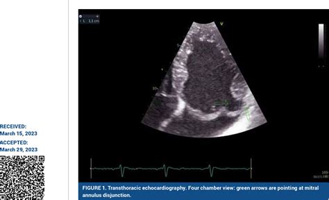Figure 1 From Mitral Annulus Disjunction And Barlows Disease In A Young Male Patient Semantic