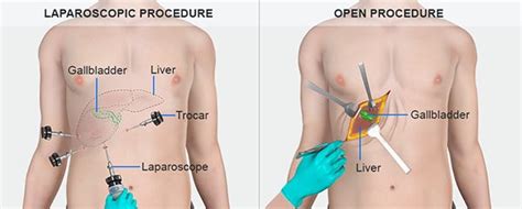 담낭절제술 Cholecystectomy요약 네이버 블로그