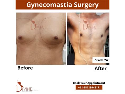 Gynecomastia Surgery And Male Chest Reduction New Delhi Quickfinds