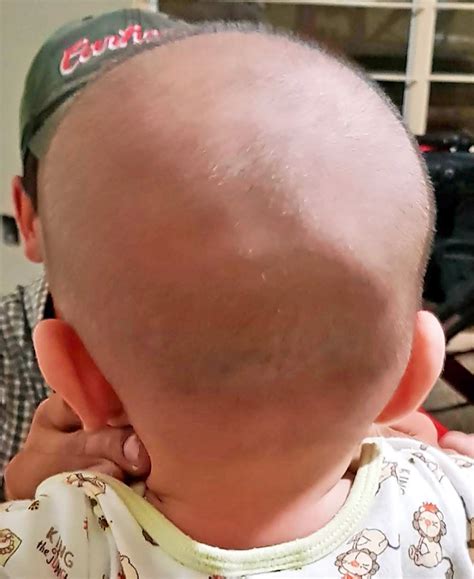 Lambdoid Craniosynostosis Neupsy Key