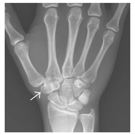 Photomicrograph Of The Osteoid Osteoma The Tumor Is Composed Of Download Scientific Diagram