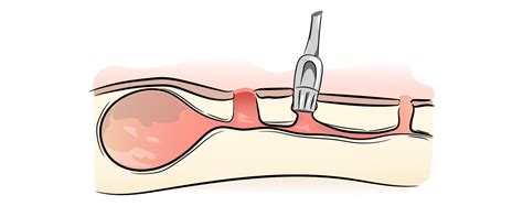 Pilonidal Cyst Laser Rfa Coloproctologie