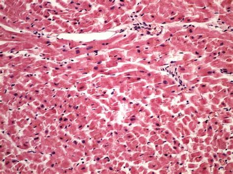 Myocardial Infarction Pathology Wikilectures