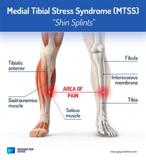 Massage Gun For Shin Splints Can It Help And Which One