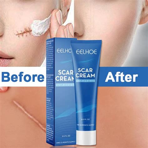 여드름 흉터 제거 크림 젤 스킨 케어 스트레치 마크 제거 여드름 반점 제거 수술용 흉터 치료 부드러운 미백 뷰티 화장품 Aliexpress