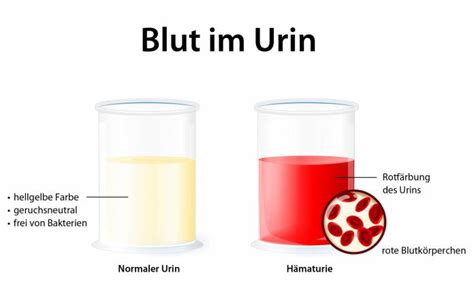 Was sind Ursachen für Blut im Urin bei einer Frau