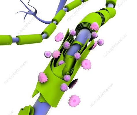 Nerve Damage In Multiple Sclerosis Stock Image C Science Photo Library