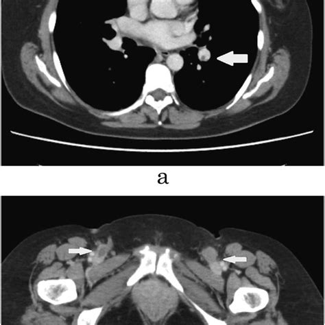 The Great Saphenous Vein On The Left Side Was Filled With Thrombus