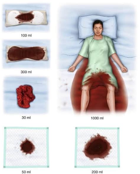 Post Partum Hemorrhage Sobrang Doc Arbie Obgyn Peri